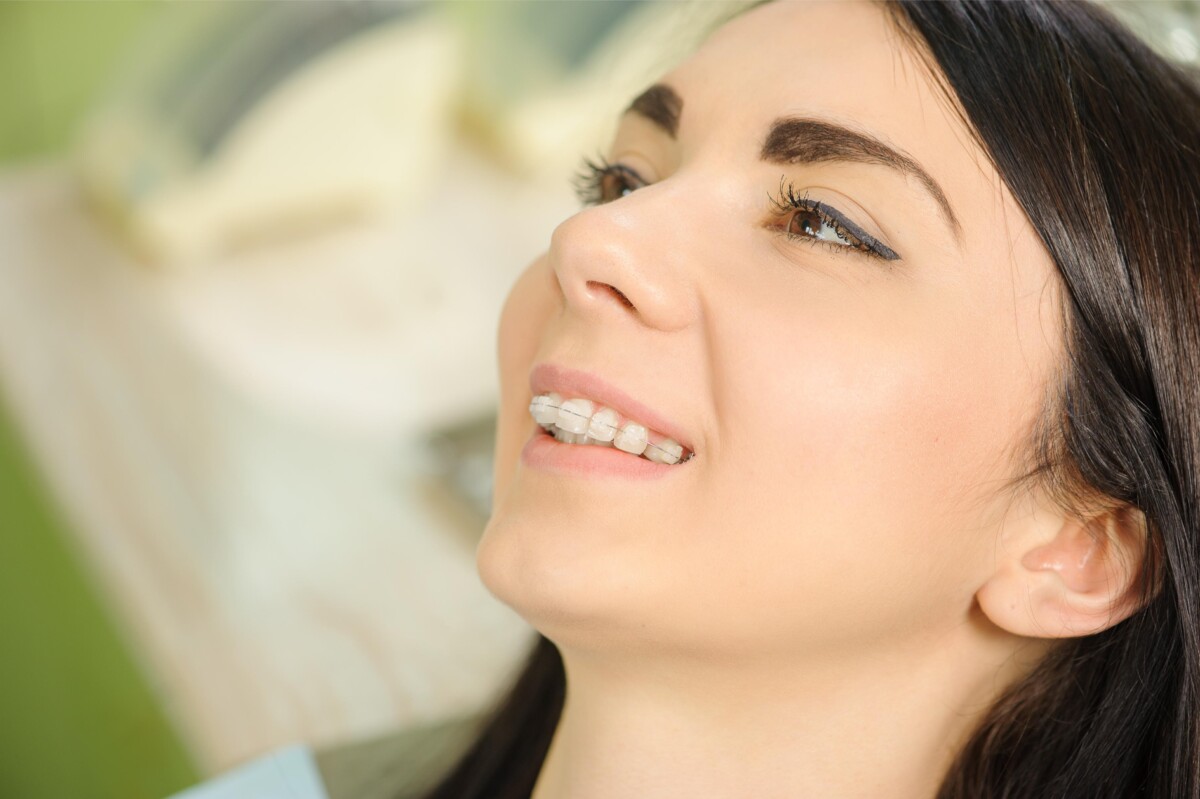 Affordable Ceramic Braces: Your Guide To A Confident Smile ...